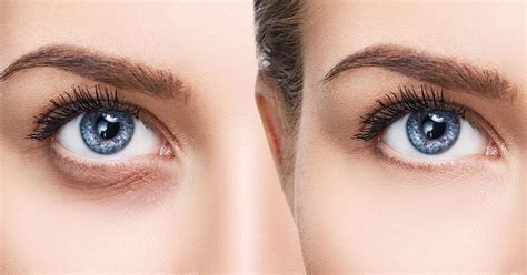 Say Goodbye To Puffy Eyes And Dark Circles With This Miracle Eye Gel