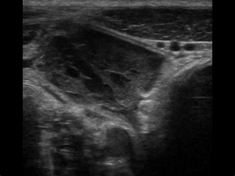 Abdomen And Retroperitoneum 1 5 Appendix Case 1 5 3 Complicated