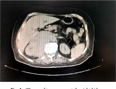 Figure 1 From A Rare Case Of Retroperitoneal Primitive Neuroectodermal Tumor Pnet Semantic