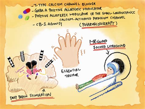 Advances In Treatments Of Essential Tremor
