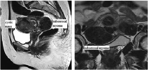 The Cystic Mass And Subserosal Lms In The Mri Download Scientific
