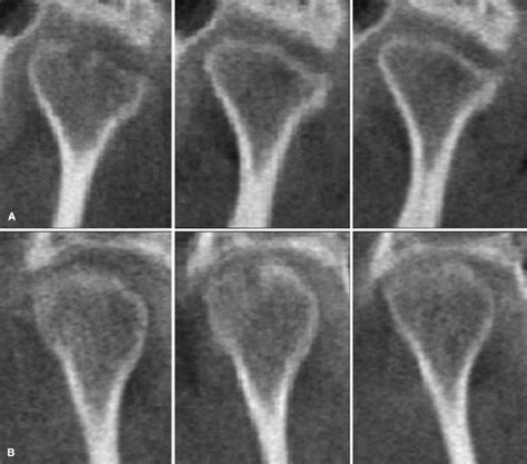 Application Of D TMJ Imaging To TMJDs TMJ Functional Analyses