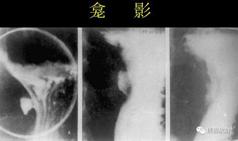 壹生资讯 胃肠道病变的基本x线表现有哪些？