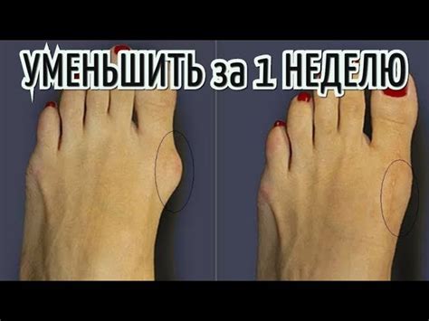 Лечение косточки на ноге в домашних условиях