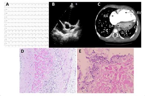 The Clinical Data A The ECG Showing A Complete Right Bundle Branch Download Scientific