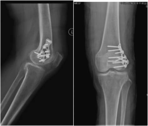 Calcaneal Reticular Plate With Cannulated Screws Fixation For