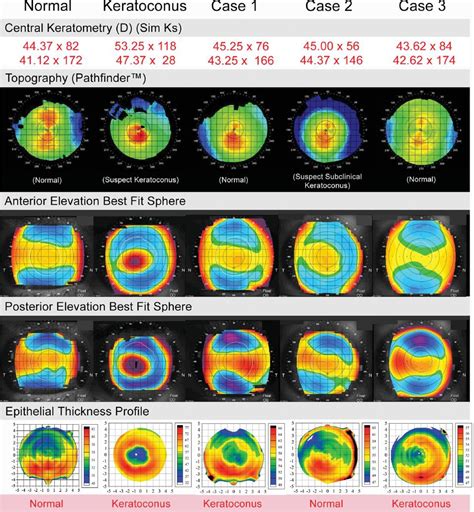 Epithelial Thickness Mapping For Keratoconus Screening By Vhf Digital