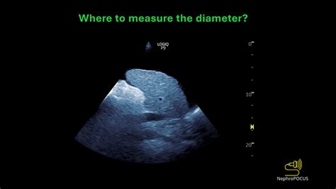 Hemodynamic Pocus In Cirrhosis Think Beyond The Ivc Nephropocus