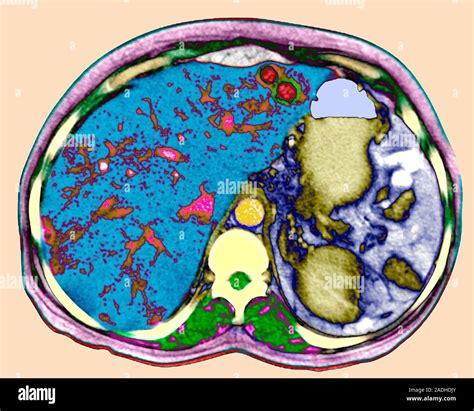 Secondary Liver Cancer Coloured Axial Computed Tomography Ct Scan