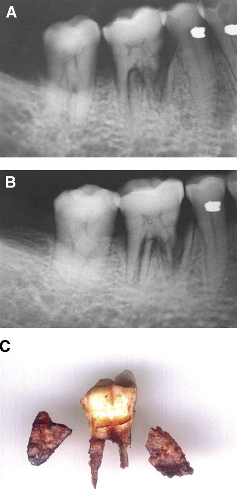Tooth Fracturecracked Tooth Causes Diagnosis And Treatments