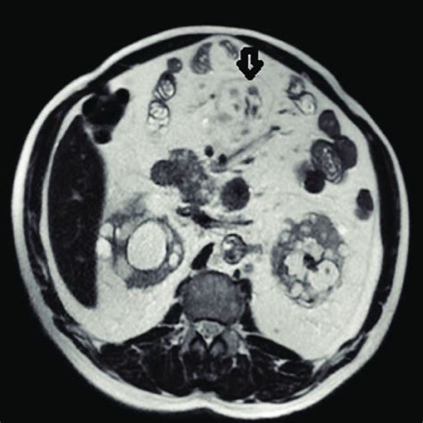 An Axial Ct Image Shows A Mesenteric Panniculitis With A Fibrotic Band Download Scientific