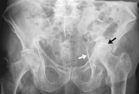 Acetabular Fractures Radiology Key