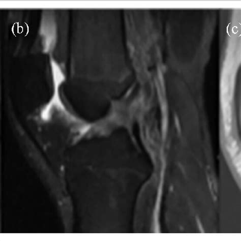 Gender Related Incidence Of Acl Injury 39 Download Scientific Diagram