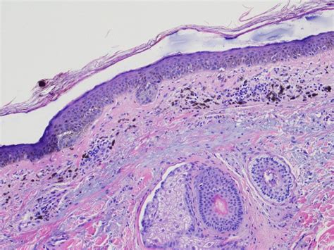 Melanoma In Situ With Partial Regression—severely Atypical Lentiginous