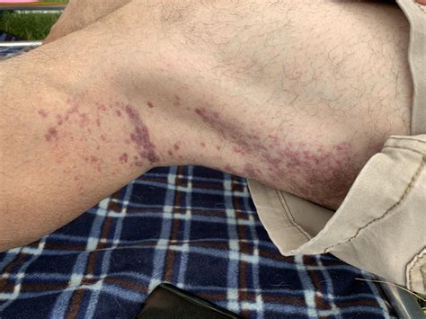 Spots On My Dads Leg Rdermatologyquestions