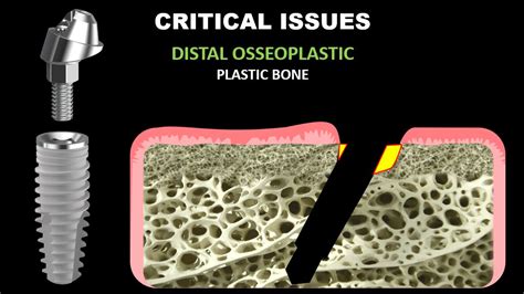 Antonello Rota On Linkedin Distal Osteoplasty Is A Surgical Procedure Involving The Removal Of A