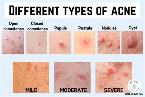Tipos De Grafico De Acne