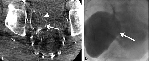 Clinical Outcomes Following Prostatic Artery Embolization In Patients With Bladder Diverticula Clinical Outcomes Following Prostatic Artery Embolization In Patients With Bladder Diverticula