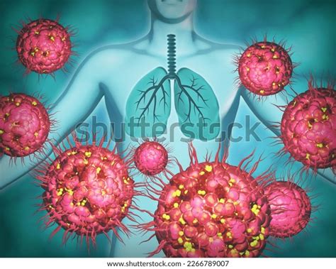Viral Respiratory Infection Lung Inflammation Concept Stock