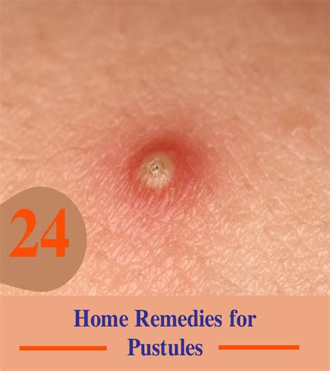 24 Home Remedies For Pustules Promohealthy