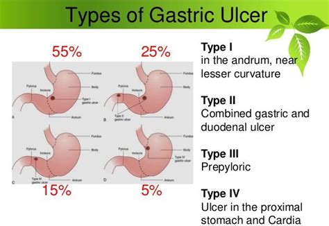 Types Of Gastric Ulcers Diagram