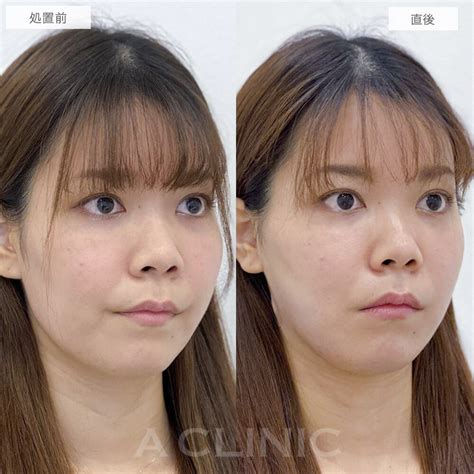 腫れや内出血は最小限で小顔に！1day小顔脂肪吸引の処置前と直後の症例です20代女性 顔の脂肪吸引・糸リフト専門の美容整形クリニックa