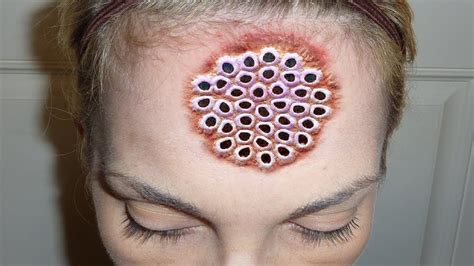 Trypophobia On Skin Why Do We Hate It Youtube