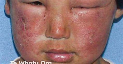 Plant Dermatitis Image Plant Dermatitis Image