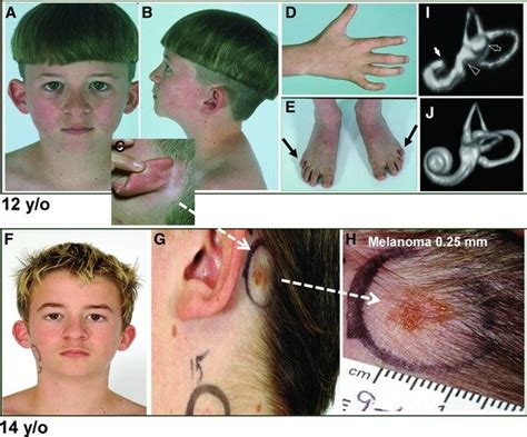 Patient Dd129be Ae At 12 Years Of Age A Facial Dysmorphism With A