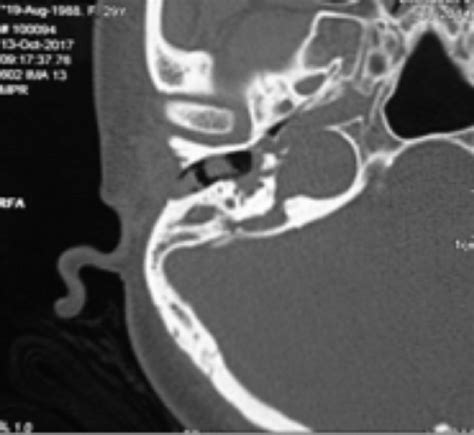 Prussak Space Ct Scan