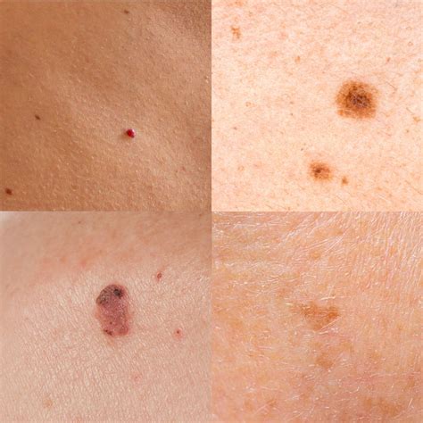 Different Types Of Melanoma And Non Melanoma Skin Cancer Skin Institute