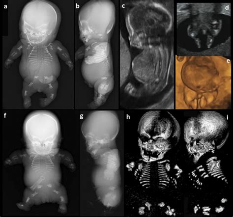 Prenatal Diagnosis Of Bone Dysplasias Pmc
