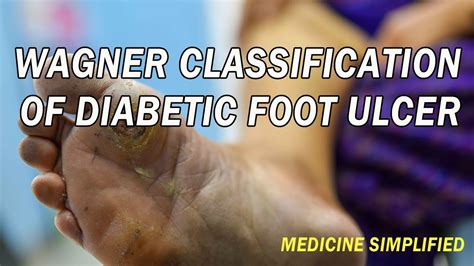 Wagner Classification Of Diabetic Foot Ulcers Diabetic Foot Ulcers Types Youtube