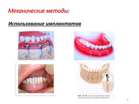 Фиксация Укрепление протеза на челюсти в покое презентация онлайн