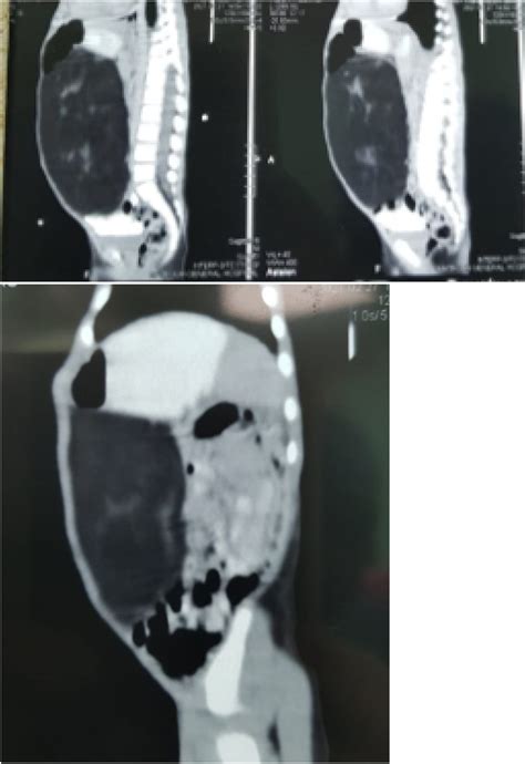 CT Scan Of The Abdomen And Pelvis Sagittal View Showing Huge Download Scientific Diagram