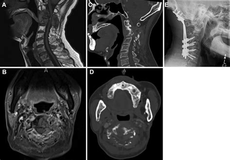 A Sagittal T1 Weighted Mri With Intravenous Gadolinium Contrast Of The