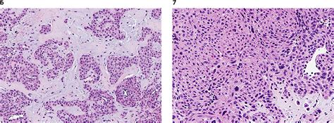 Rupture Of A Subungual Glomus Tumor Of The Finger Bmc
