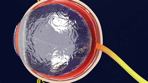 Posterior Vitreous Detachment Types Eye 3d Model Blender Market