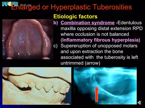 32preprosthetic Surgical Procedures N Ppt