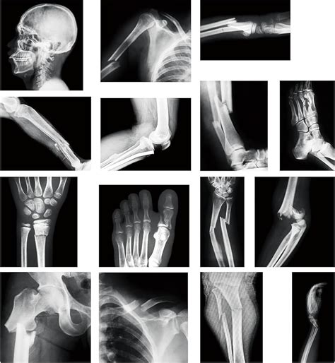 Ankle Bones X Ray