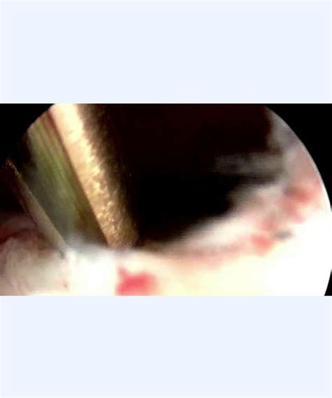 Polypectomy With Resectr 5 Fr Tissue Resection Device Dr Dick Schoot