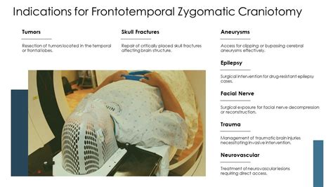 Frontotemporal Zygomatic Craniotomy Ppt Powerpoint Acp Ppt Slide