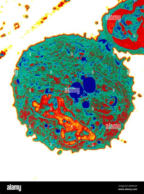 Cancer Cell Coloured Transmission Electron Micro Graph TEM Of A