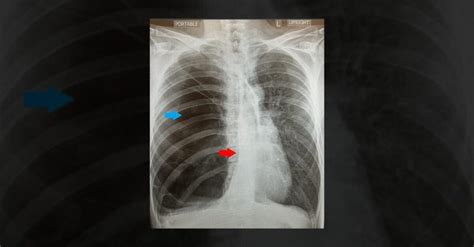 Rare Cause Of Pleural Effusion In This Middle Aged Woman Medsynapse