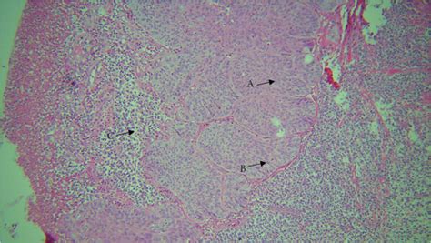 10× View A Basaloid Cells B Mitotic Figure And C Inflammatory Cells Download Scientific