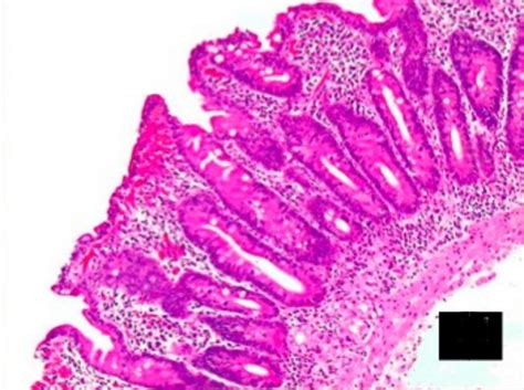 Using Marsh Scores To Diagnose Celiac Disease