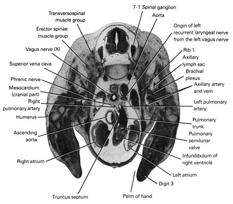 Infundibulum Of Right Ventricle