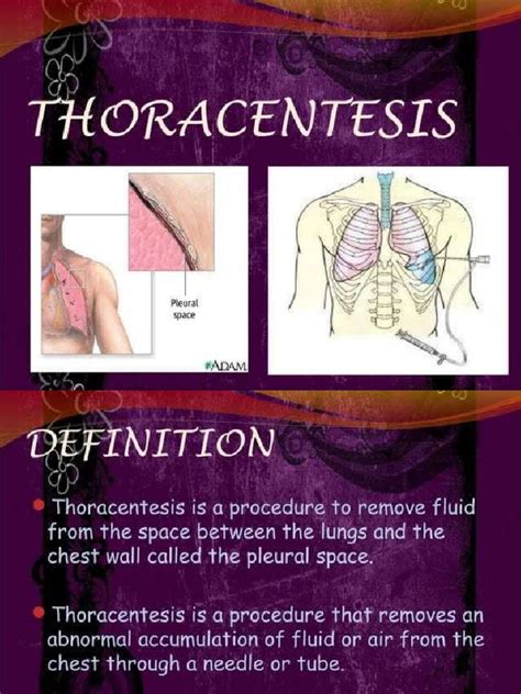 Thoracentesis Pdf
