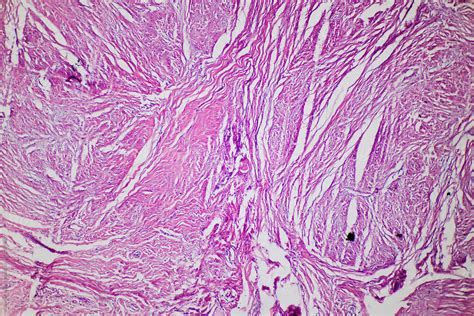 Connective Tissue Hyaline Degeneration Of Human By Stocksy