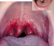Lecture 6 Streptococcus Flashcards Quizlet